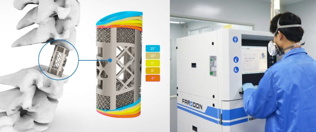 Porous Titanium Spine Fusion Cage Produced on Farsoon Metal Systems ...